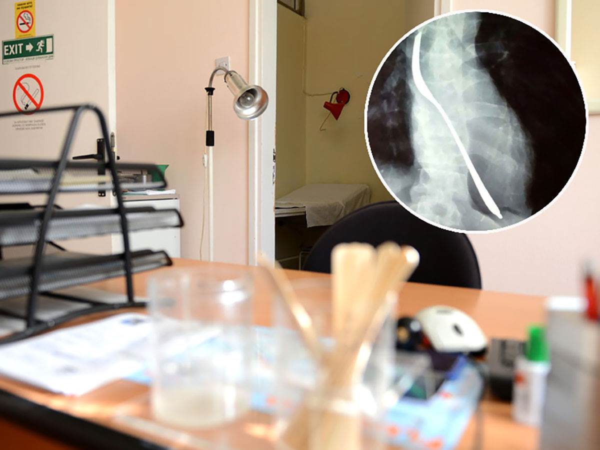 Pacijent u Srbiji progutao viljušku | Mondo