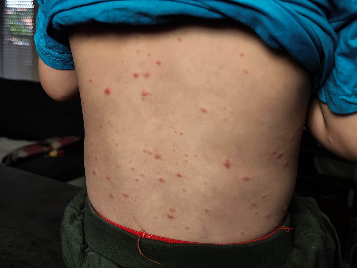 Morbile simptomi i komplikacije | Mondo