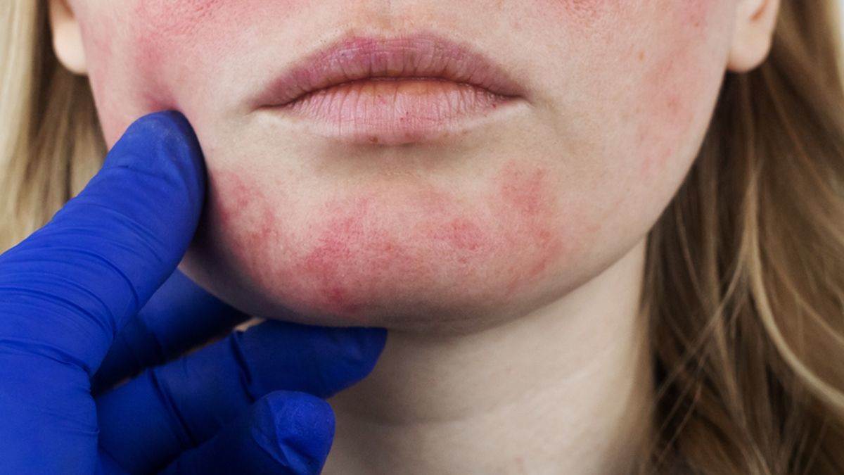 Simptomi na licu pokazuju sa kojom hranom preterujemo | Mondo