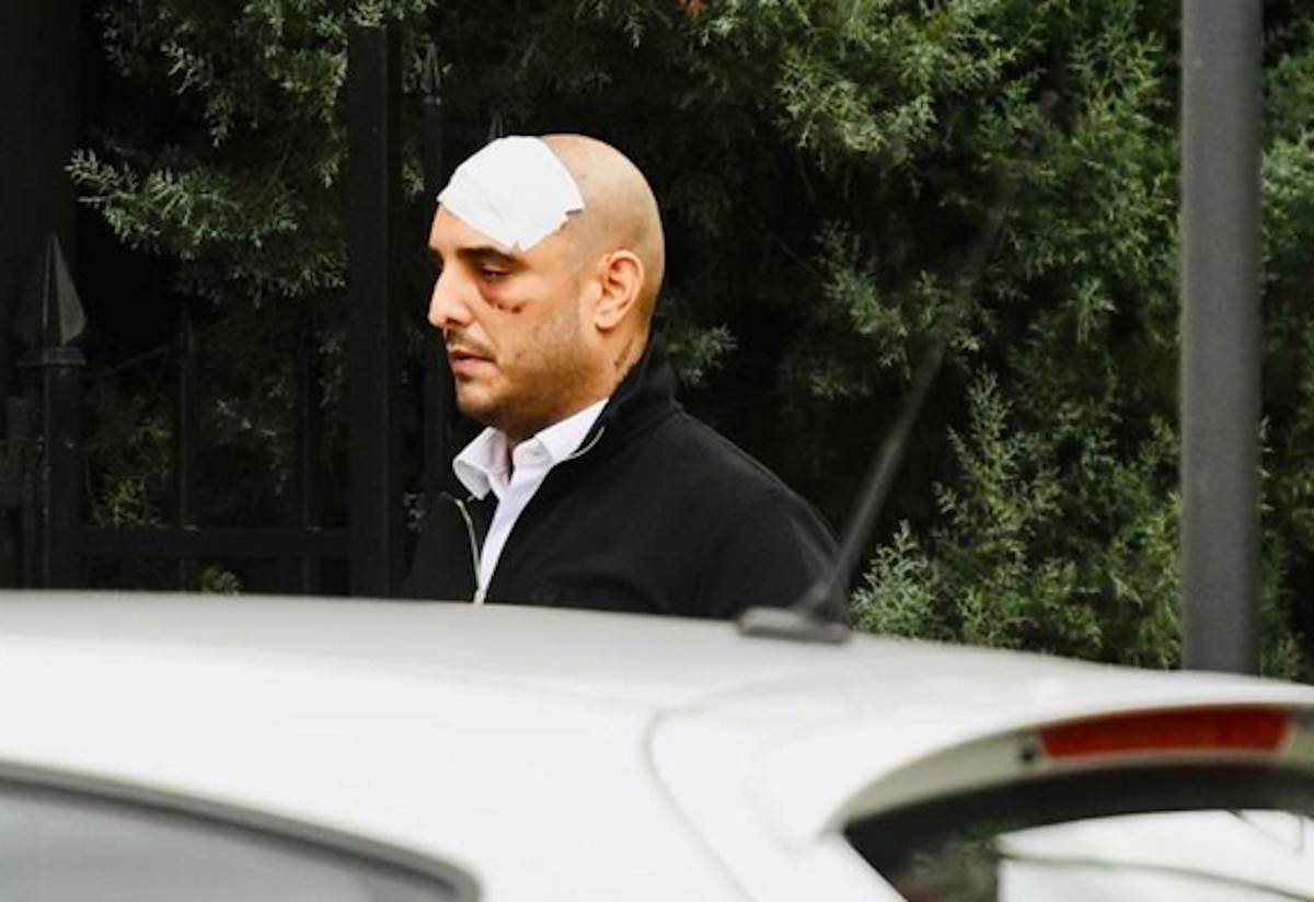 Modrice ispod oka i zavoj na glavi: Paparaco fotke Darka Lazića ...
