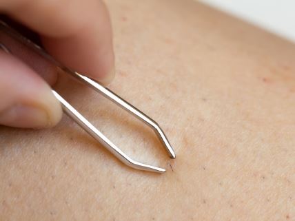 Kada je urasla dlaka opasna i kako je izlečiti | Mondo